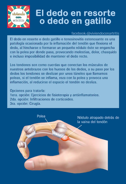Viviendo con artritis: El dedo en resorte o dedo gatillo