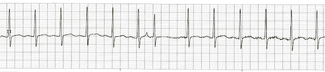 ECG Rhythm Strips 80