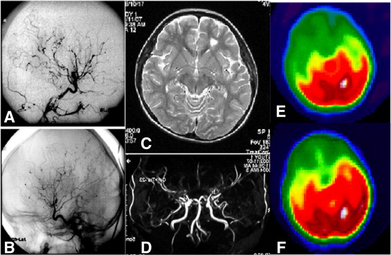 Medical sharing: Cerebral angiography indications