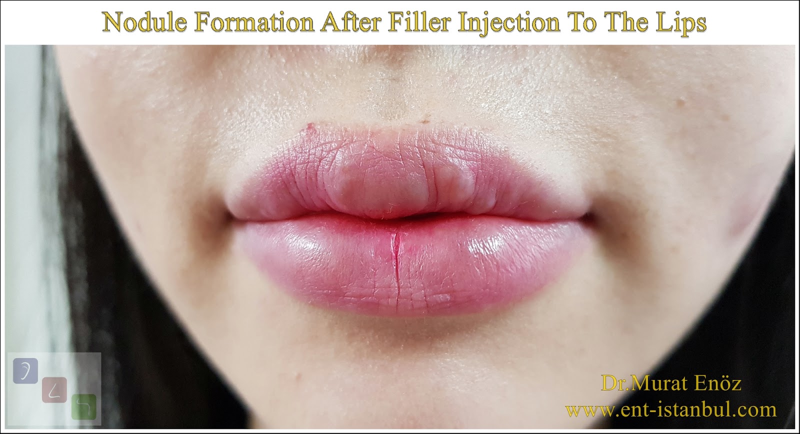 Nodule Formation After Filler Injection To The Lips nodule-formation-after-filler-injection-to-the-lips