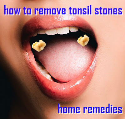 How To Remove Tonsil Stones - 10 Remedies For You - herbal tea reciPes