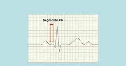 telemedicina EKG: segmento PR