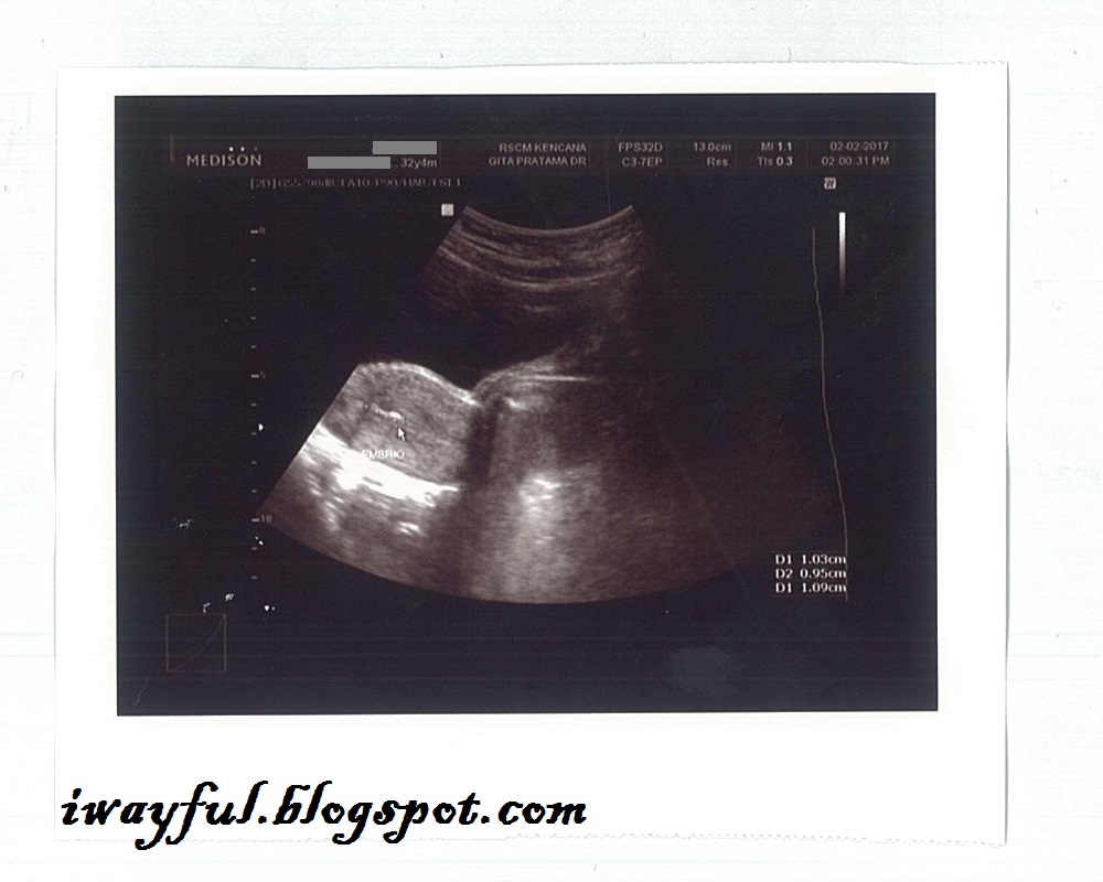 Welcome to Iwayful Blog: IVF (FET): Frozen Embryo Transfer (h+15)
