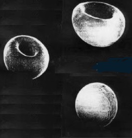 Grupo de Estudos Aplicados à Hematologia: Esferocitose Hereditária