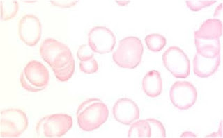 Biometria Hematica: Alteraciones de los Eritrocitos