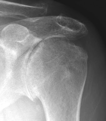 UW Shoulder and Elbow Academy: Rheumatoid arthritis of the shoulder, x ...