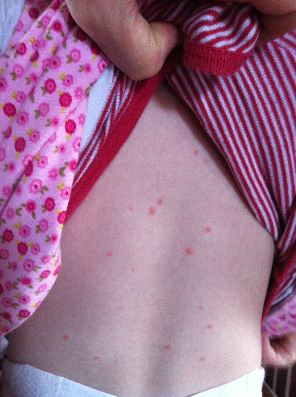 Velaroma- die dufte Pflegepraxis: Windpocken, wilde Blattern, spitze ...