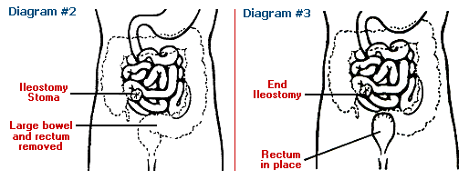 Medical Treatment Pictures-for Better Understanding: Ileostomy Surgery ...
