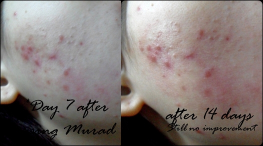Journey on Beauty : Review: Murad Acne Complex Starter Kit