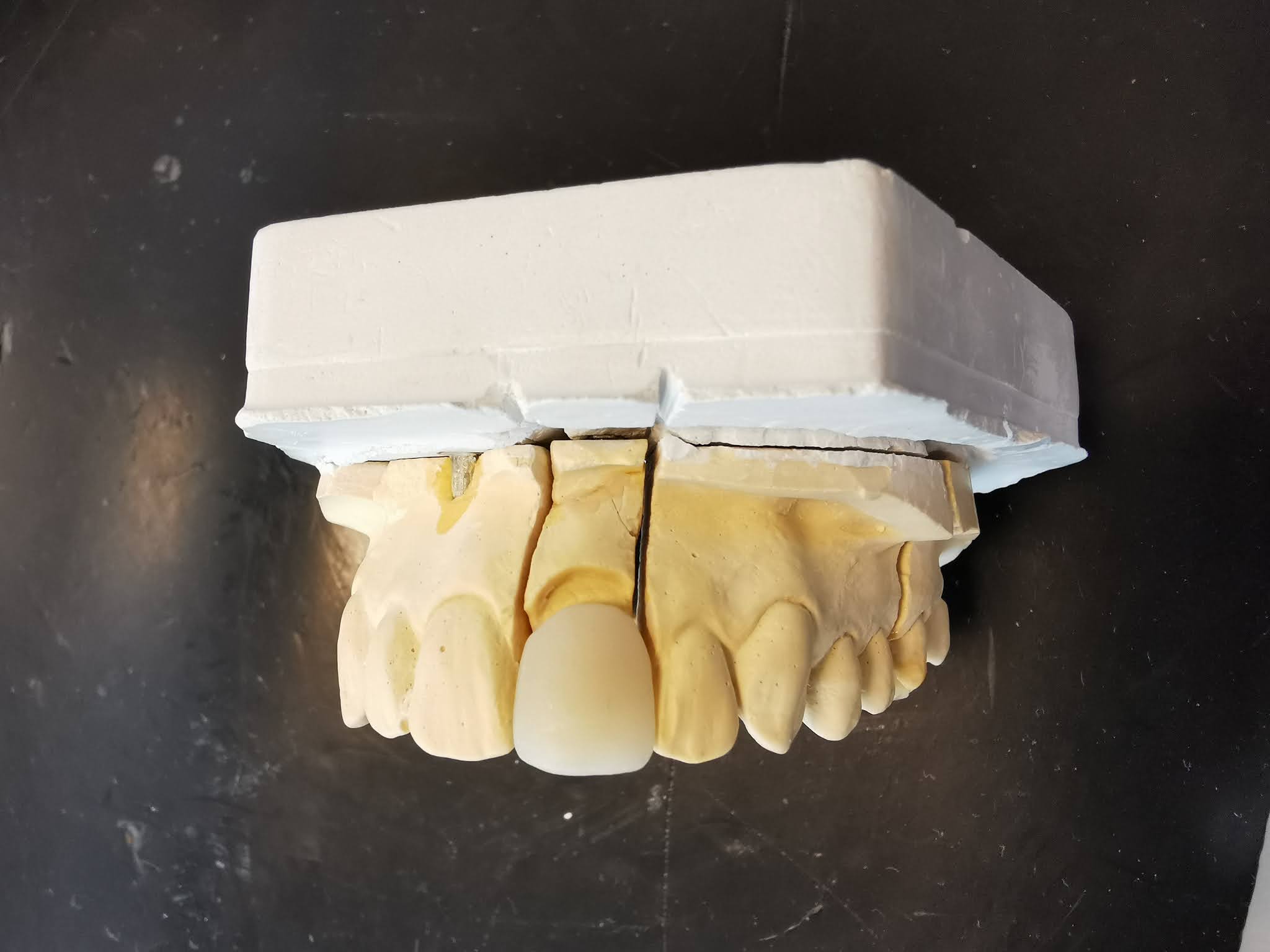 1. INCISIVO DE CERÁMICA INYECTADA