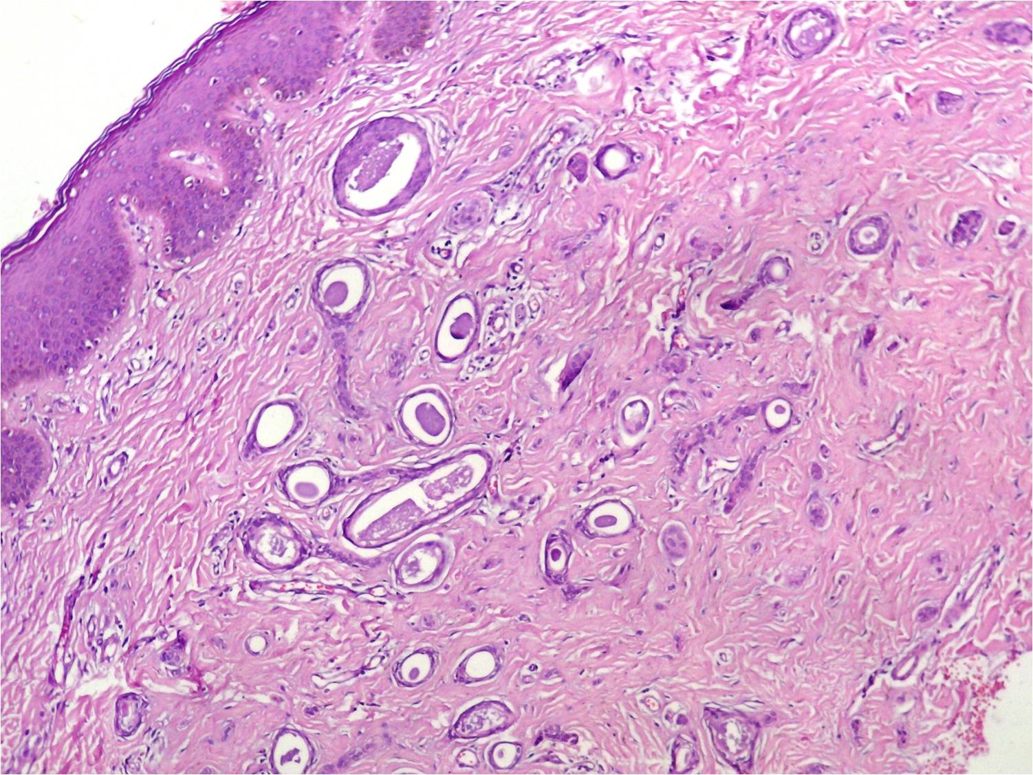 UNIDAD DE DIAGNÓSTICO ANATOMOPATOLÓGICO.: SIRINGOMA VULVAR