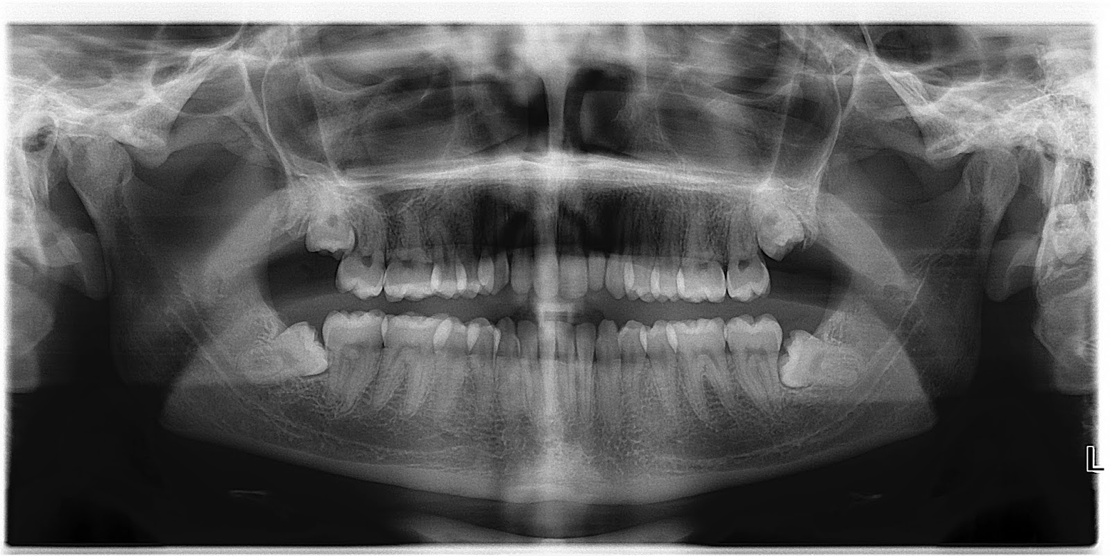The Annoyance of Wisdom Teeth ~ Tina Reed Orthodontics