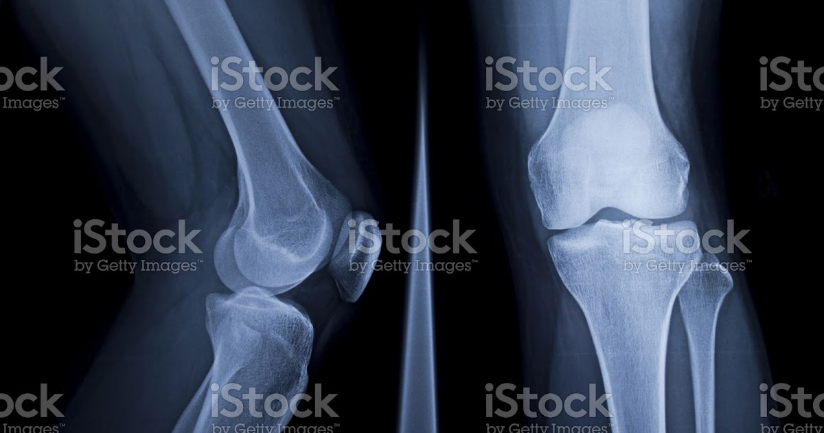 What is Bone? Explain the Classification of bone.