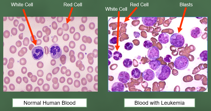 KNOWLEDGE: KELAINAN LEUKOSIT