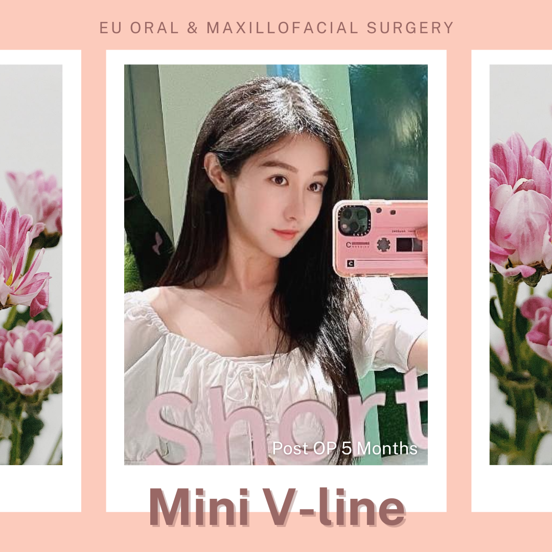 What is mini V-line Surgery?