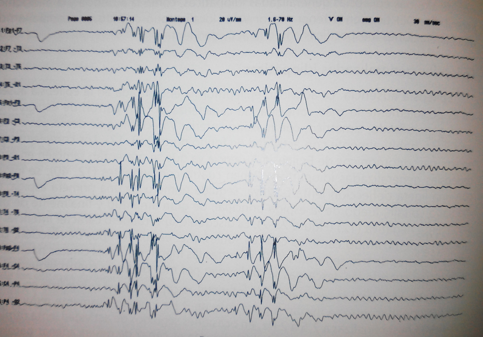 Electroencefalografía en las epilepsias. | ¿Que es la epilepsia?
