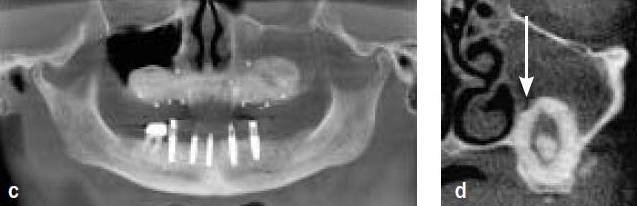 Sinus lift or sinus bump for implants - Bauer Smiles
