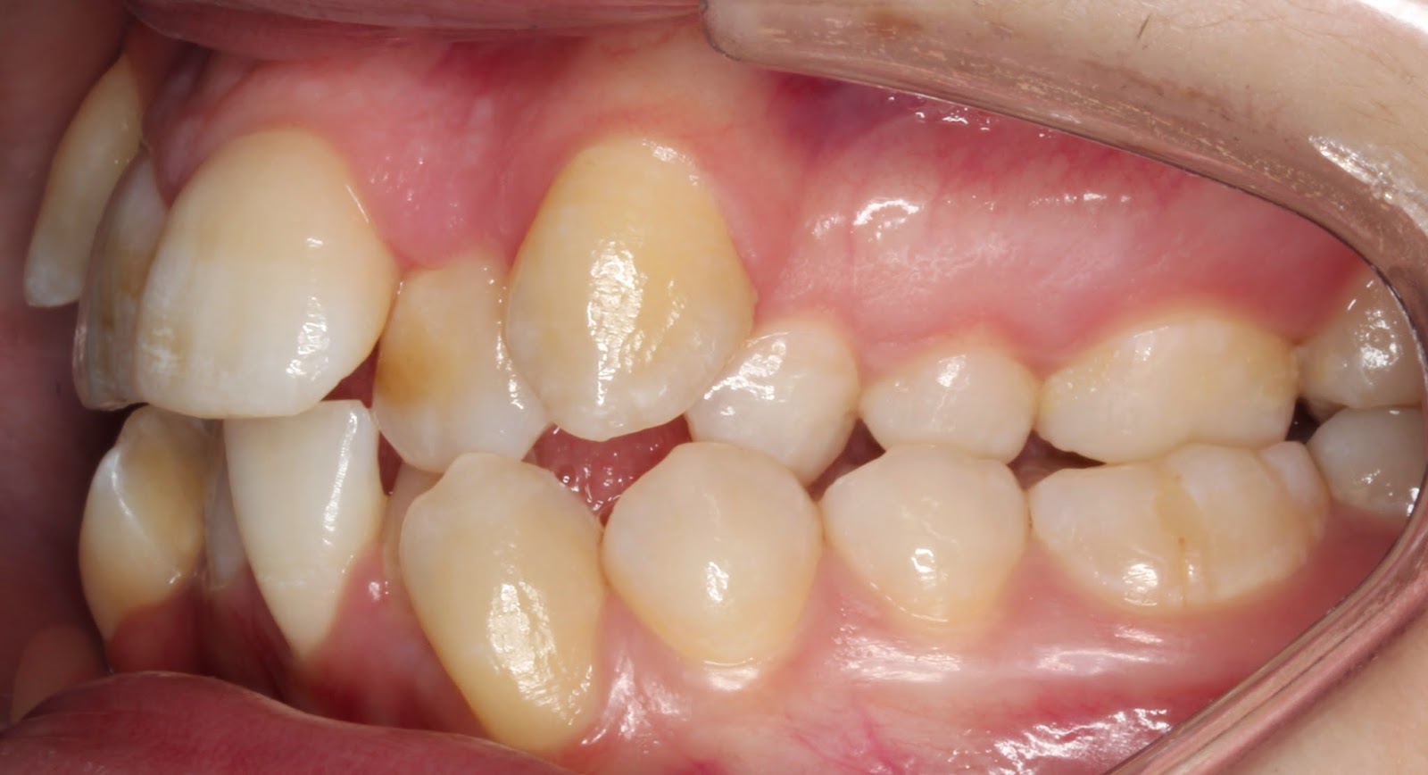 Getting My Teeth Fixed!! :)