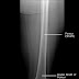 TEKNIK RADIOGRAFI FEMUR - Radiografer
