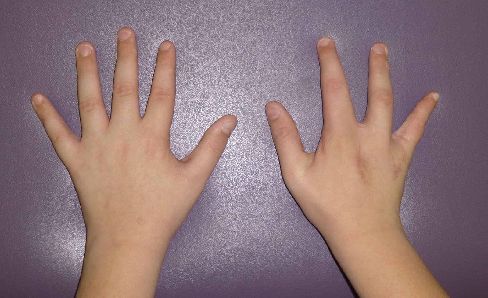 Cleft Hand Long Term Follow- up | Congenital Hand and Arm Differences ...