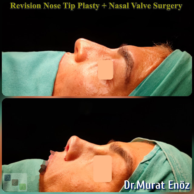 Revision Nose Tip Plasty in Istanbul