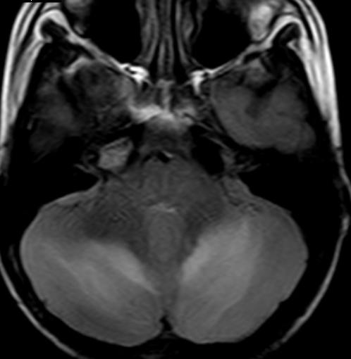 Acute Cerebellitis-is it infectious or post infectious? - Sumer's ...