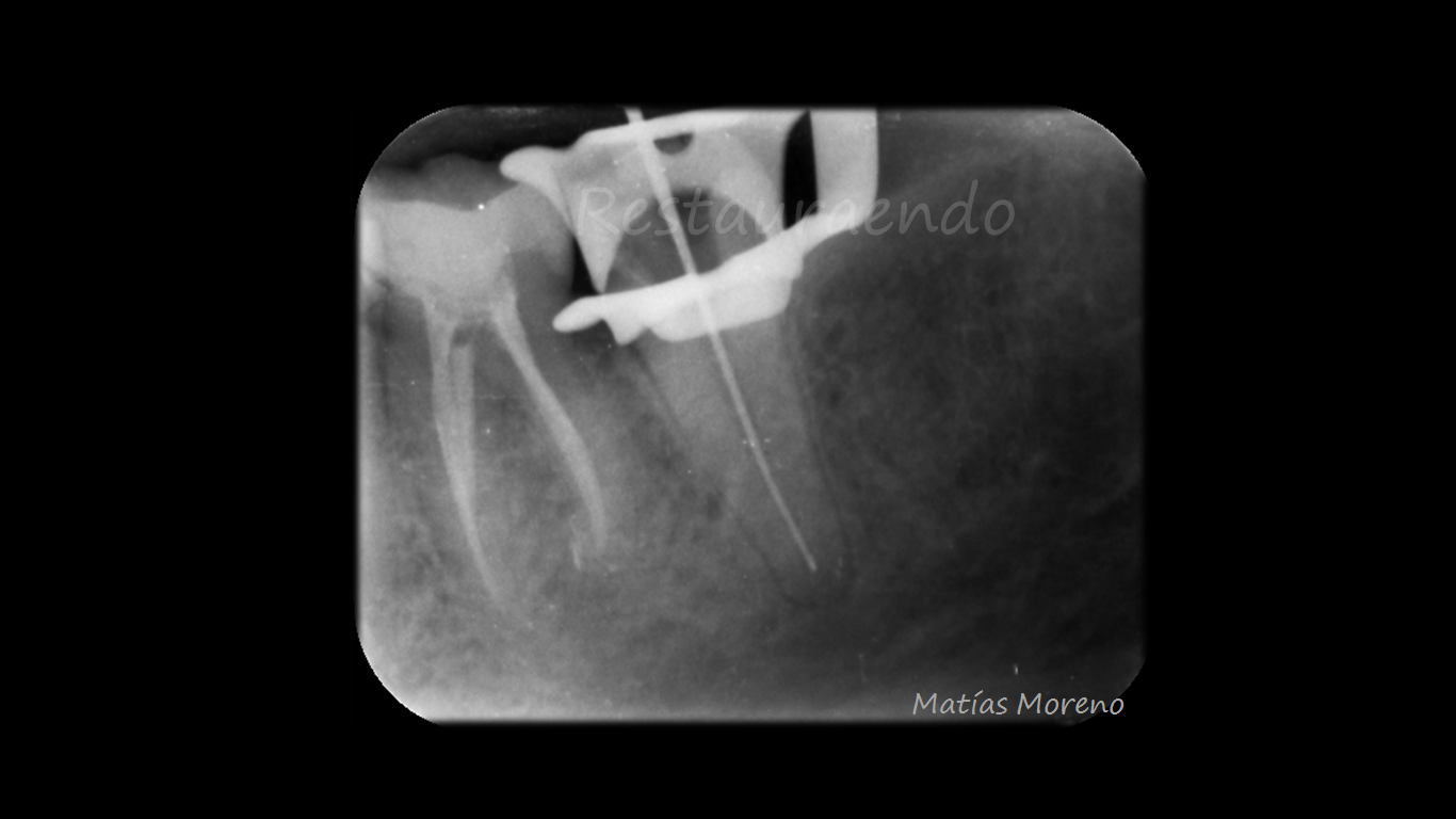Máster en Odontología Restauradora y Endodoncia: Tratamiento de ...