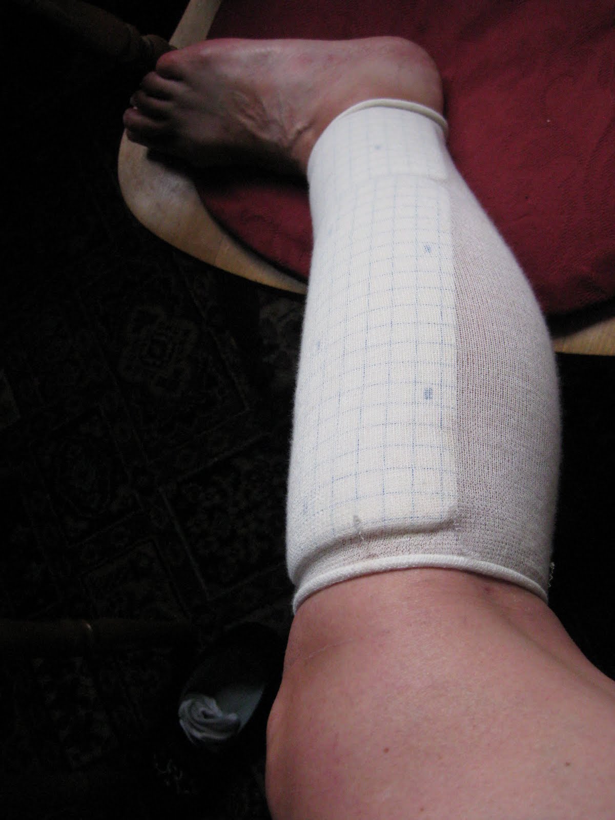 Gills RSD (CRPS): JULY-OUCH