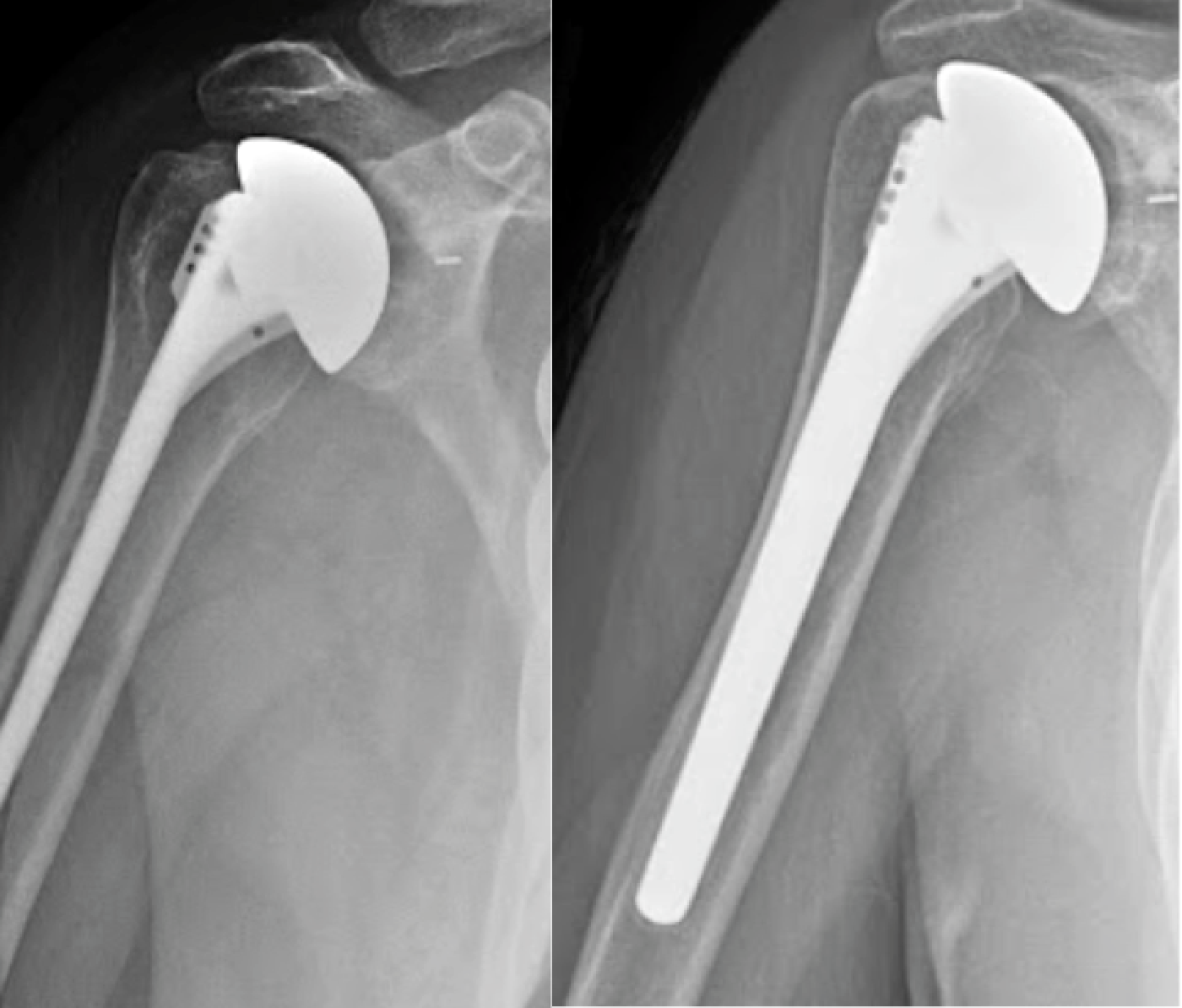 UW Shoulder and Elbow Academy: Short stemmed humeral implants - what we ...