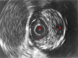 Angiografía y Terapia Endovascular: IVUS - OFDI