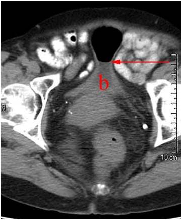 Radiologist For Ever: Male pelvis rule16 : Urinary bladder fistula