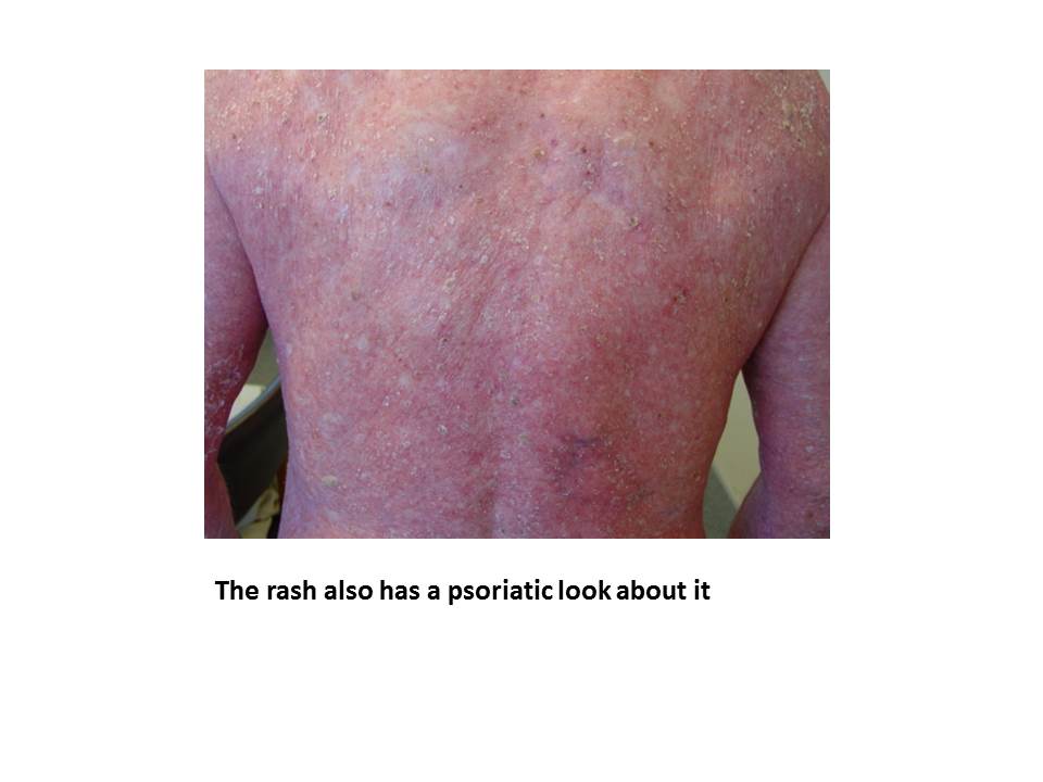 Consultations in Dermatology: Pityriasis Rubra Pilaris