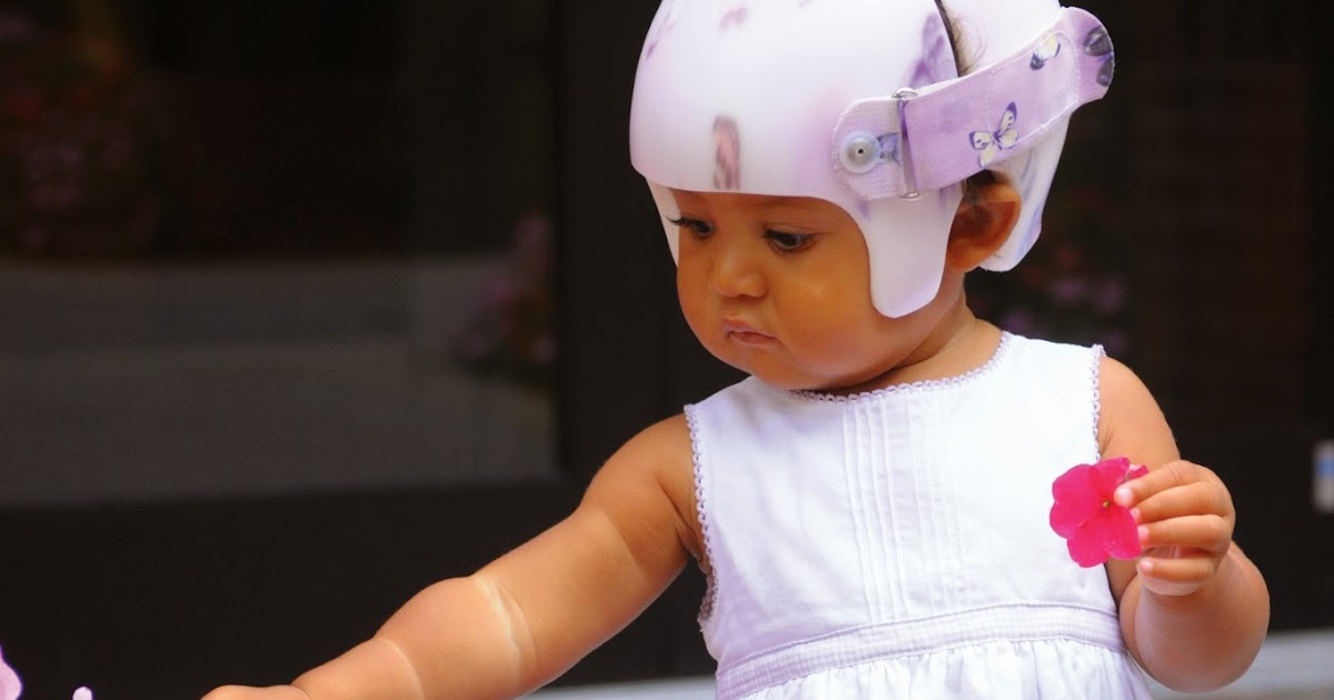 CRANIAL- Plagiosefali (Düz Kafa Sendromu) ve Diğer Kafatası Şekil ...