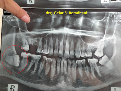 Mau Cabut Gigi, Kenapa Harus Foto Rontgen Terlebih Dahulu?