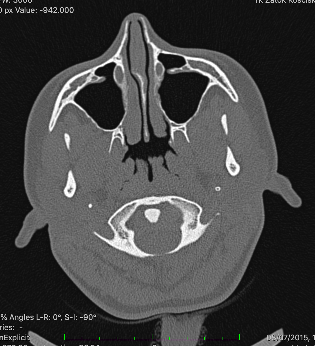Eustachian tube dysfunction...forever?: My never-ending ear problem