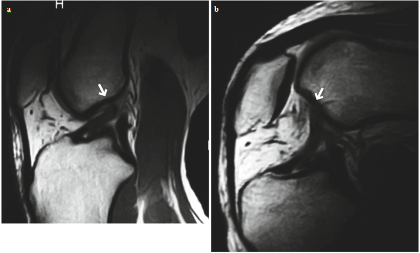 MRI Dây Chằng Chéo Trước (ACL)