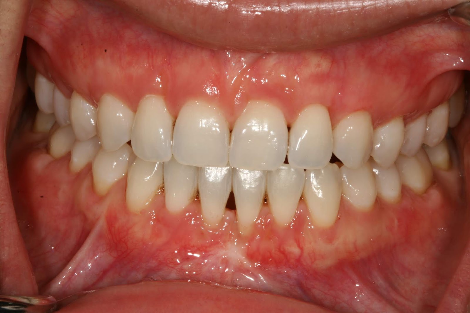 Gum Graft Diary and Survival Tips