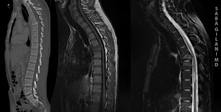 Roentgen Ray Reader: Post-traumatic Syrinx