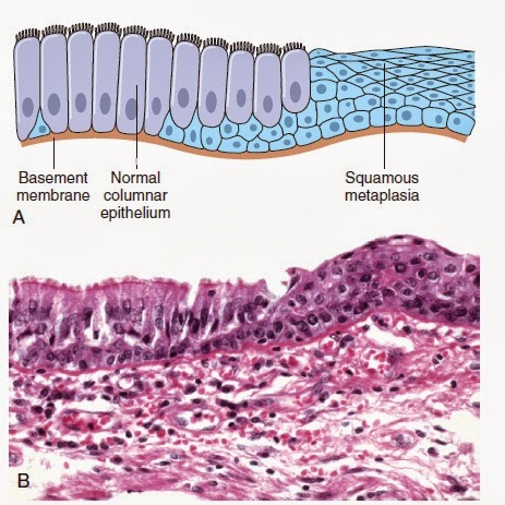 Qu'est-ce que métaplasie?