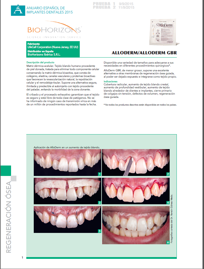 Dr.Meda: Caso clínico tratado con Alloderm publicado en el Anuario ...
