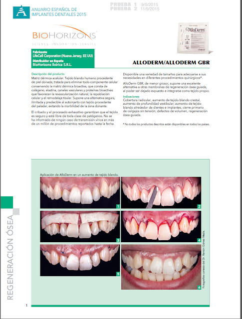 Dr.Meda: Caso clínico tratado con Alloderm publicado en el Anuario ...