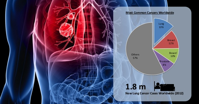 Lung most cancers One-yr. Survival rate improves inside the UK - CANCER