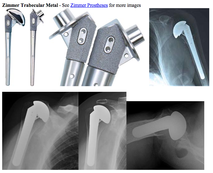 Shoulder and Elbow Surgery: Identifying the implanted shoulder ...