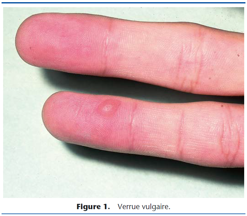 Verrues - Documents de Médecine