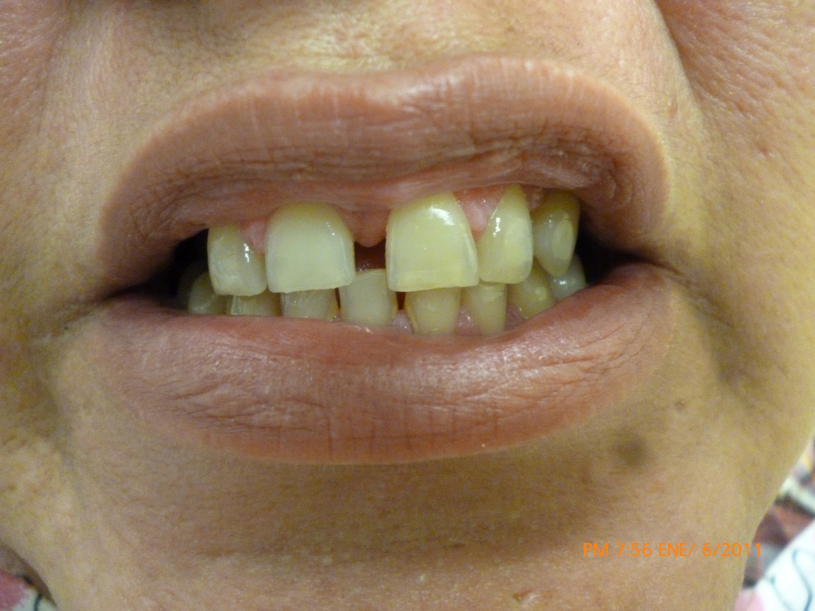 LIZZ DENTAL: Protesis Totales