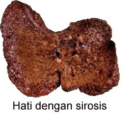 Cirrhosis Hepatic - Public Health - 2011