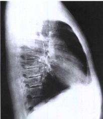 Chest : Lateral Projections - RadTechOnDuty