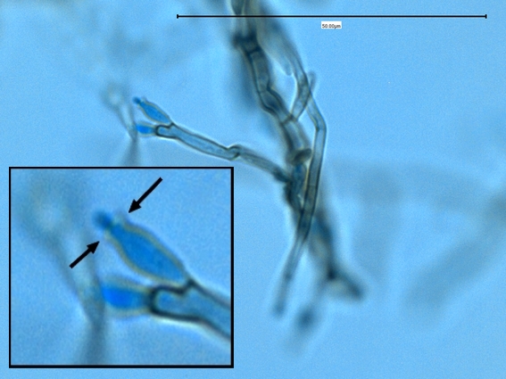 Fun With Microbiology (What's Buggin' You?): Fonsecaea pedrosoi/monophora