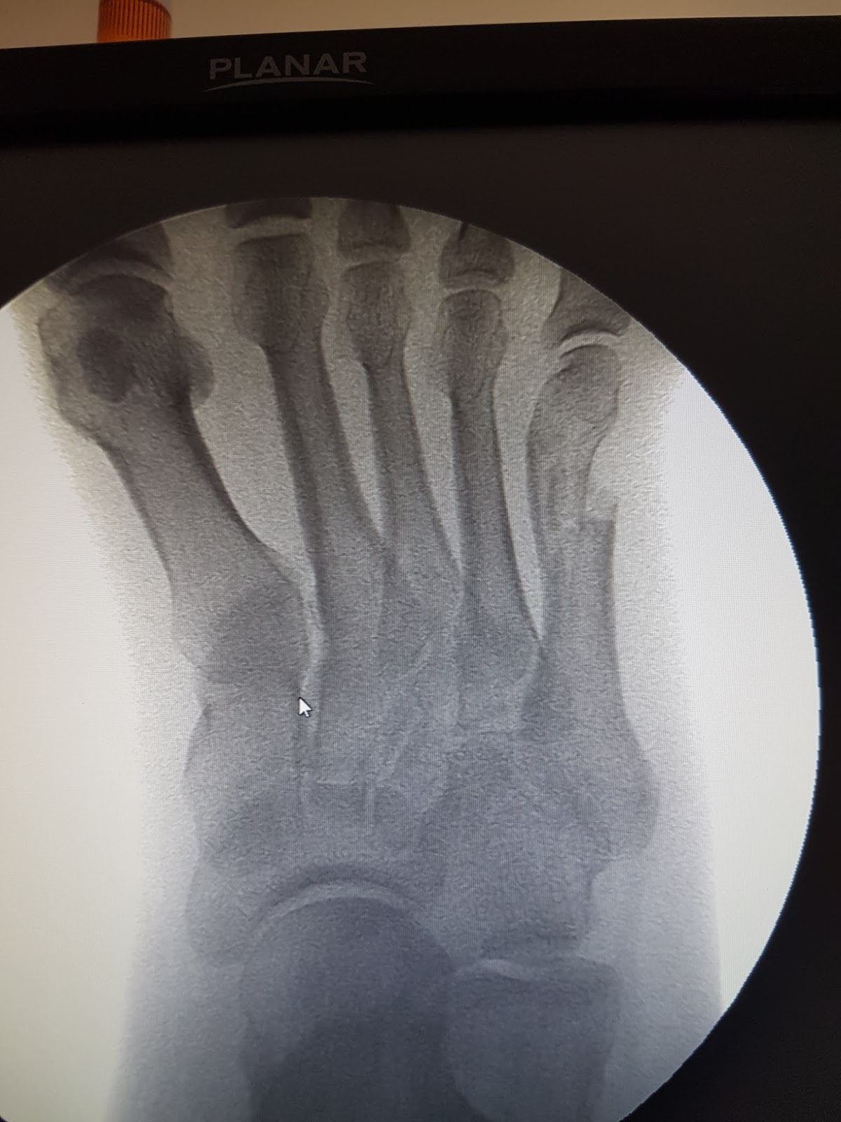 Podo Basas al Día: Alargamiento de gastrocnemio. Papilomas con ...