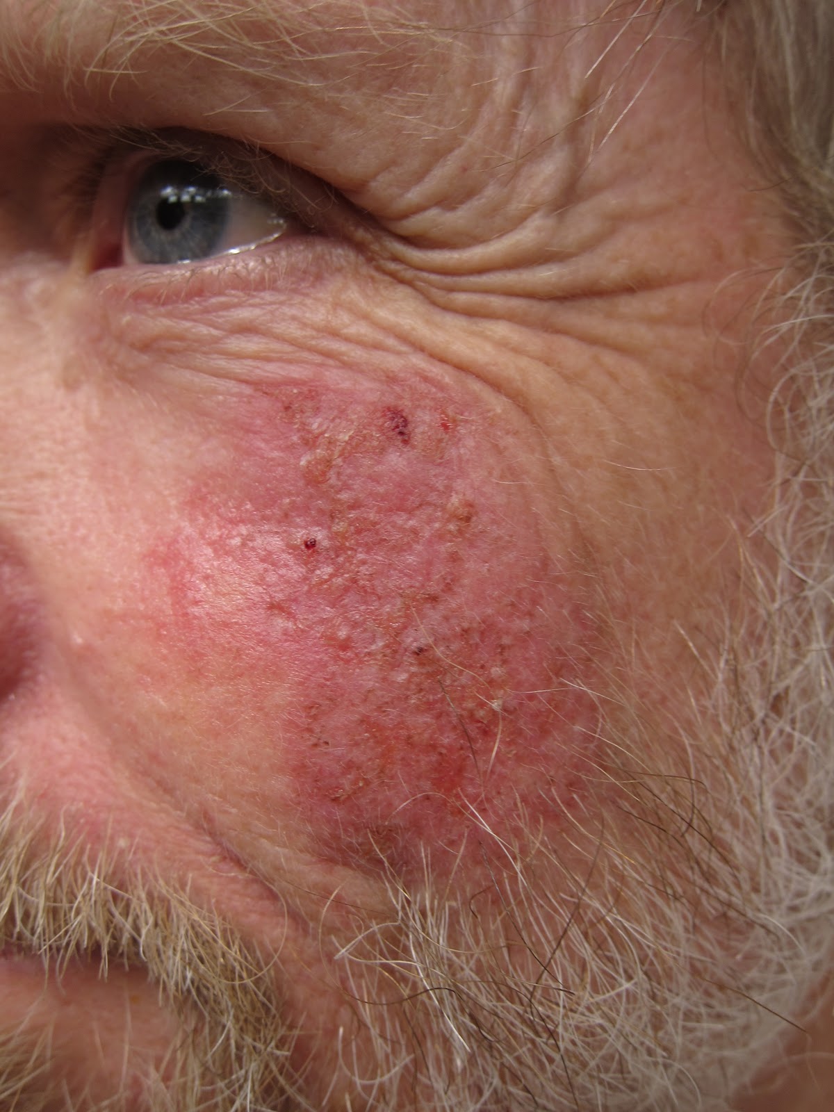 Efudex - Round Two: Four weeks and done